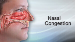 Blocked Nose 24/7? Understand the Causes and How to Get Relief - Dr ...